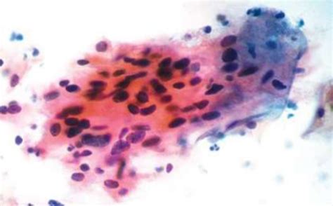 Cytologic Criteria Flashcards Quizlet