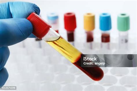 원심분리 후 혈액 샘플의 시험관을 들고 있는 실험실 기술자 혈액검사에 대한 스톡 사진 및 기타 이미지 혈액검사 Platelet Rich Plasma 혈청 표본