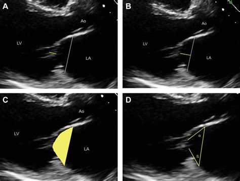 Echocardiographic Evaluation Of Mitral Leaflet Tenting A Coaptation Download Scientific