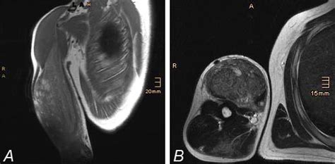 Magnetic Resonance Image Of Swollen Biceps Muscle After Intramuscular