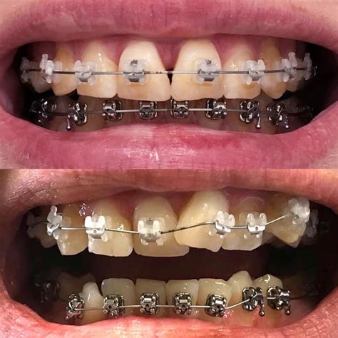 6 Months Progress Braces