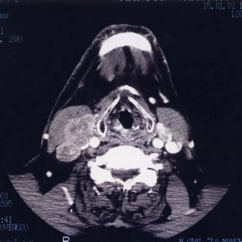 Adenopatías Cervicales En Región Submandibular Derecha Download
