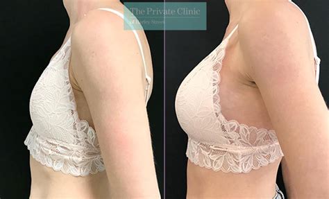 Breast Implants Before And After Dd