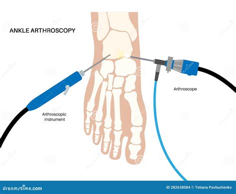 Ankle Arthroscopy Poster Vector Illustration CartoonDealer Com 282638084