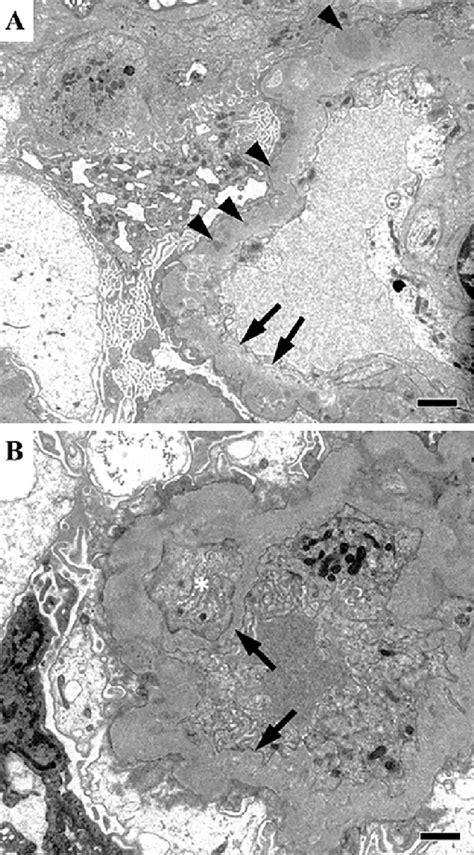Figure3electron Microscopic Findings Of The Renal Biopsy Electron Download Scientific Diagram
