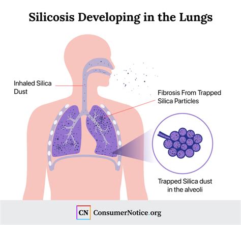 Everything You Need To Know About Silicosis