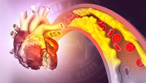 Obicetrapib Cuts Ldl C In Patients With Hefh Multidisciplinary Mims Singapore