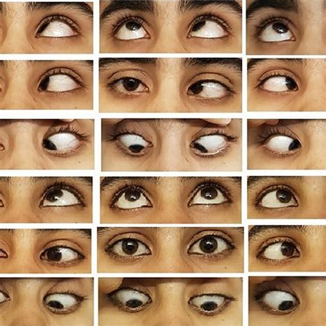 A An 18 Year Old Lady With An Esotropia Of 83 Pd And A “v” Pattern Of Download Scientific