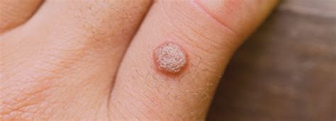 Verrugas Na Pele As Verrugas São Pequenos Crescimentos Benignos Na