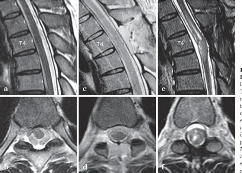 Figure 3 From Idiopathic Spinal Cord Herniation With Dura Defect Repair