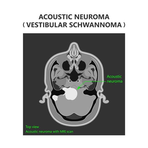 Vestibular Schwannoma Acoustic Neuroma Advanced Vestibular Clinics