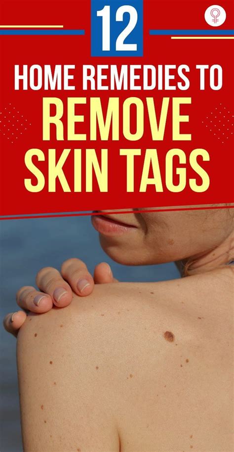 12 Home Remedies To Remove Skin Tags Naturally Artofit