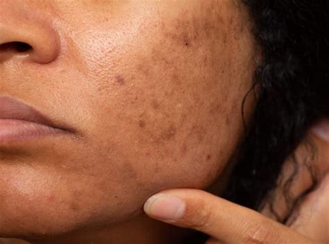 How To Remove Dark Spots On Face Naturally And Safely