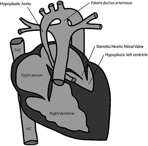 Hypoplastic Left Heart Syndrome Review Of Stage I Palliation