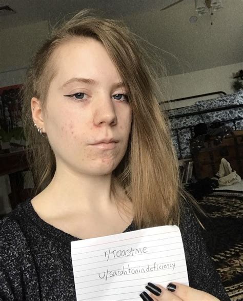 18 Year Old Covered In Facial Scarring Who Fell In Love For The First