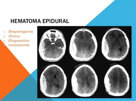 Hematoma Subdural Epidural Intraparenquimatoso
