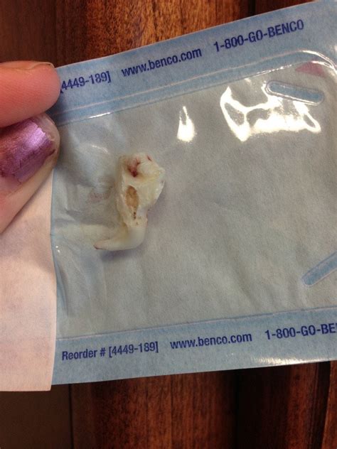 Nasty Hooked Root On A 3rd Molar R Dentistry