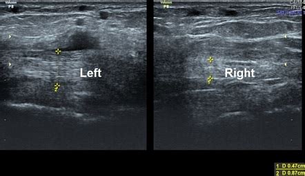 Posterior Tibial Tendon Ultrasound