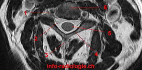 Cervical Spine Mri Anatomy W Radiology