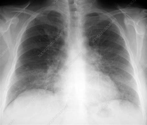 Interstitial Pneumonia Of Lungs X Ray Stock Image C0037227