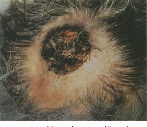 Figure 1 From Angiosarcoma Of The Scalp Semantic Scholar