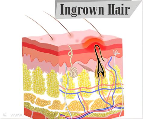 Ingrown Hair Causes Symptoms Dfxk