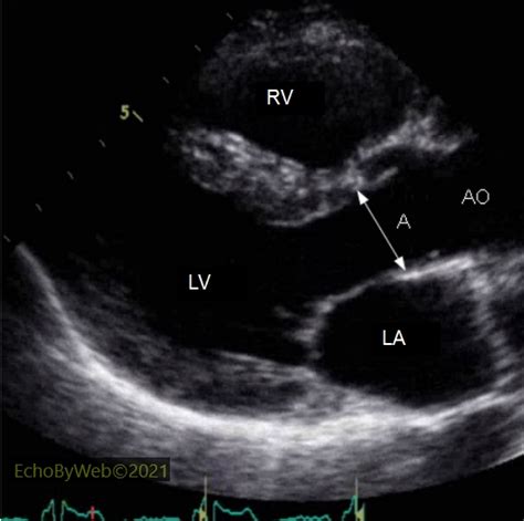 Echocardiography Online Analysis Of The Aorta