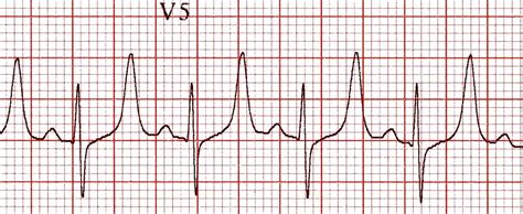 Ecg Features Of Hyperkalaemia Hyperkalemia Emergency Management