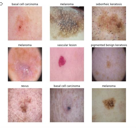 GitHub Hansa15100 Melanoma Detection Skin Cancer Detection