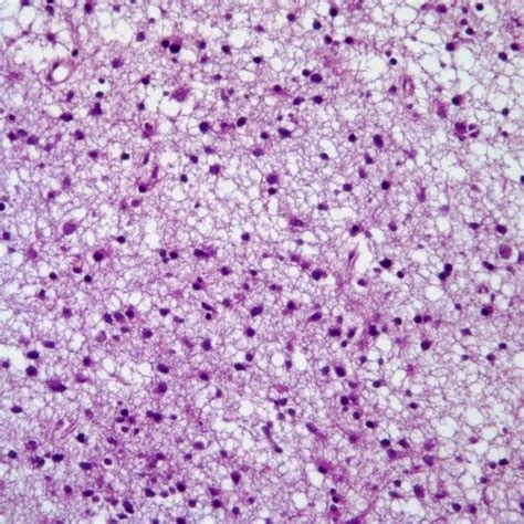 Fda Grants Fast Track Designation To Vorasidenib In Idh Low Grade Glioma