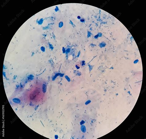 Mycobacterium Tuberculosis Acid Fast Stain
