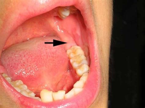 Swollen Gums At The Back Of The Mouth Detroit Chinatown