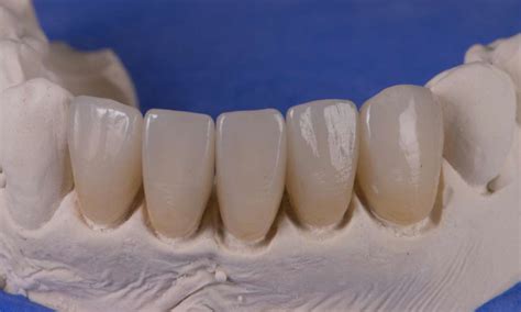Lower Anterior Teeth