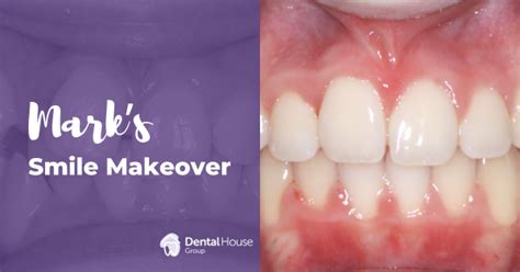 Mark Of Melbournes Fixed Braces Journey Greenvale Dental House