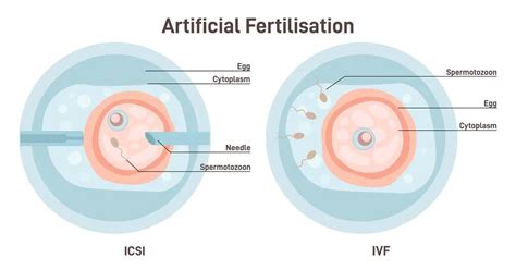 ICSI Vs IVF Difference Between IVF And ICSI Grace Fertilty