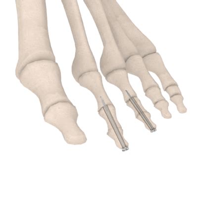 Hammertoe Correction Digital Compression Screw