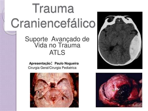 Ppt Trauma Craniencef Lico Powerpoint Presentation Free Download Id