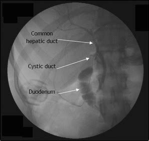 Intraoperative Cholangiogram The Operative Review Of Surgery