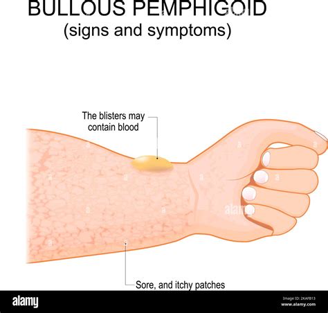 Bullous Pemphigoid Autoimmune Pruritic Skin Disease Skin Condition Of