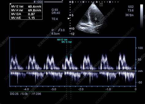 Diastolic Dysfunction Echocardiogram Stock Image F041 8360 Science Photo Library