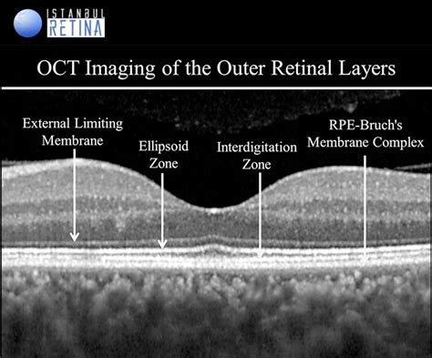 Retinal Layers Oct