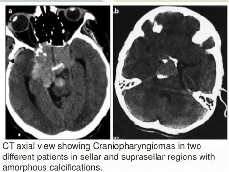 Physiological And Pathological Calcification Of Brain