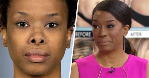 2 Women Share Their Stories Of ‘botched Plastic Surgery