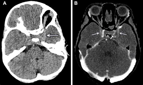 Imaging The Cerebral Veins In Pediatric Patients Beyond Dural Venous
