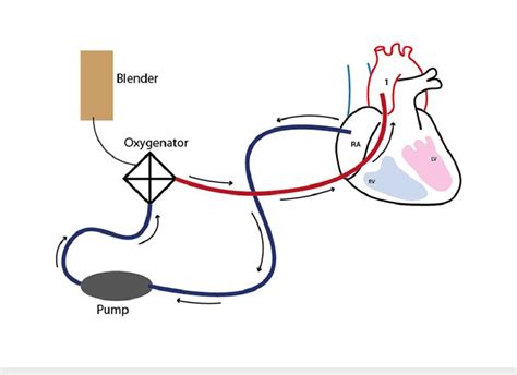 Central Cannulation For Venoarterial Extracorporeal Membrane