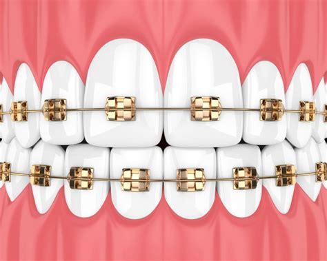 Marsh Orthodontics Cary Nc Orthodontist Braces And Aligners