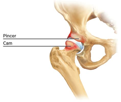 Cam Type Femoroacetabular Impingement Radiology At Eileen Towner Blog