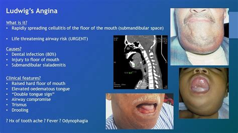 Submandibular Abscess