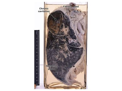 Pathology Tuberculosis Lectures Pptx