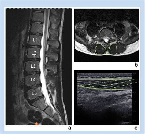 Figure 1 From Lumbar Multifidus Morphology In Youth Competitive Alpine Skiers And Associated Sex